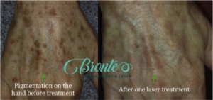 Age spots hands laser treatment | Bronte Dermatology, Laser & Cosmetic ...
