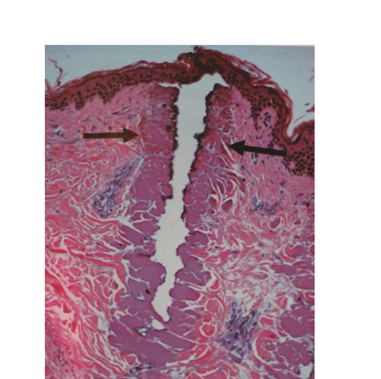 Histology Of Fractional Co2 Laser Treatment Of Skin Bronte Histology Of Fractional Co2 Laser Treatment Of Skin Bronte